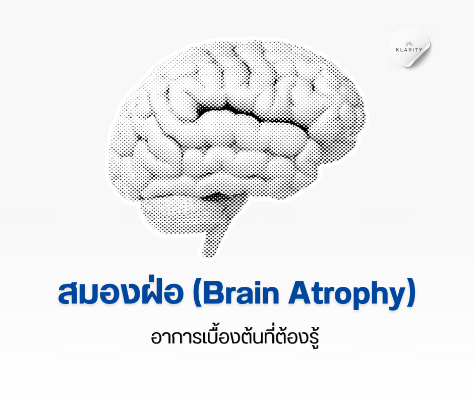 “สมองฝ่อ” (Brain Atrophy) อาการเบื้องต้นที่ต้องรู้ – KLARITY